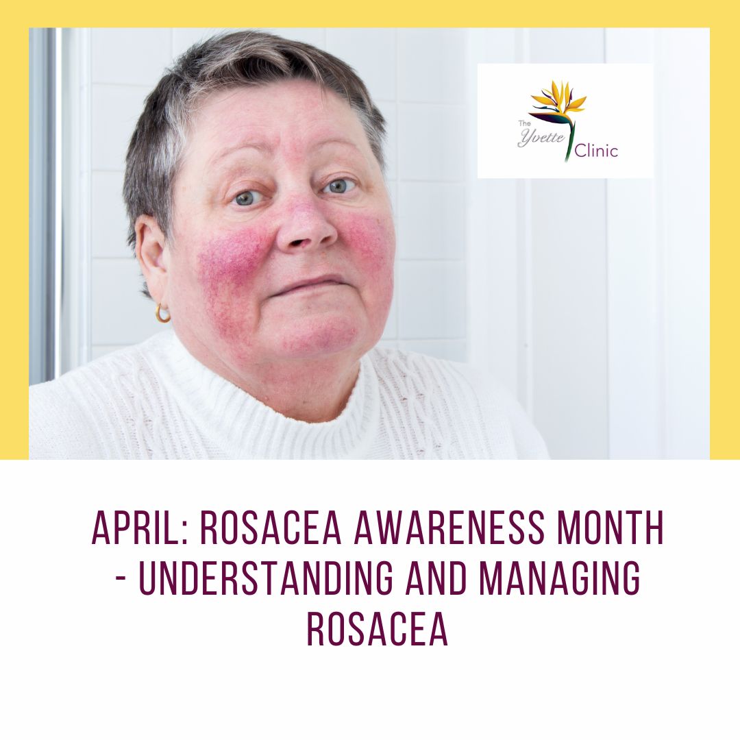 April: Rosacea Awareness Month - Understanding and Managing Rosacea ...